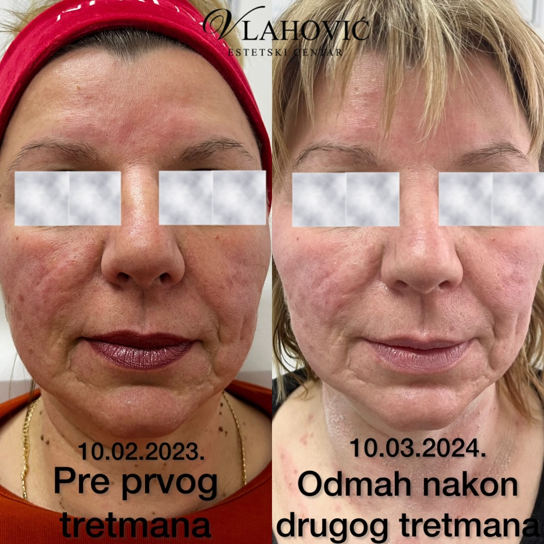 HYDRAFACIAL - regeneracija i rejuvenacija kože - Estetski centar ...