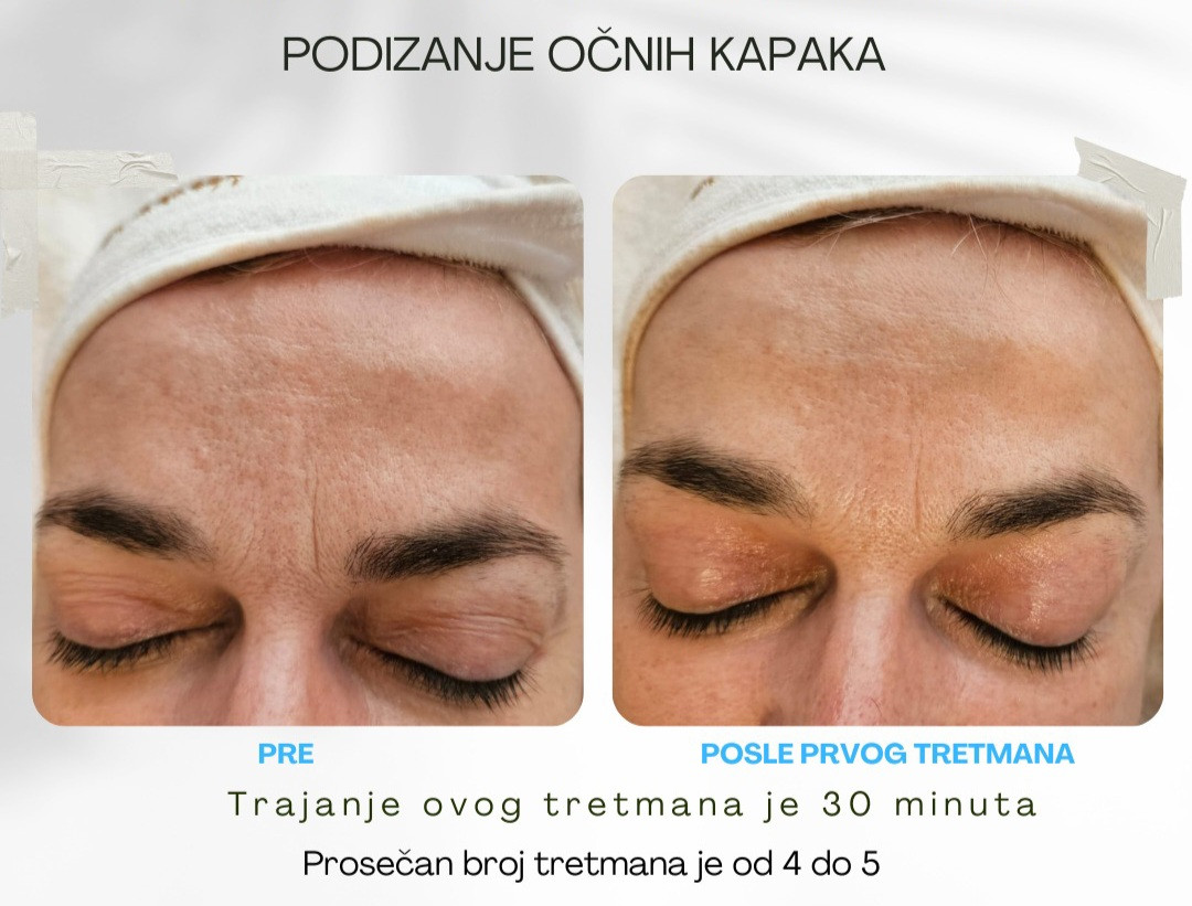 Tesla MED - Blefarokil (podizanje kapaka) - Viva Derm, Beograd Tretman ...