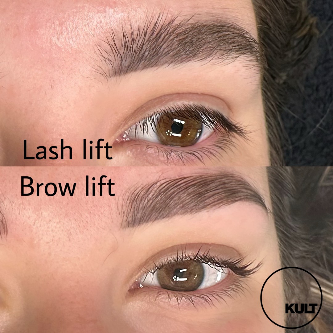 Brow lift + botox - Kult, Beograd Obrve #W4EYL8 - SrediMe