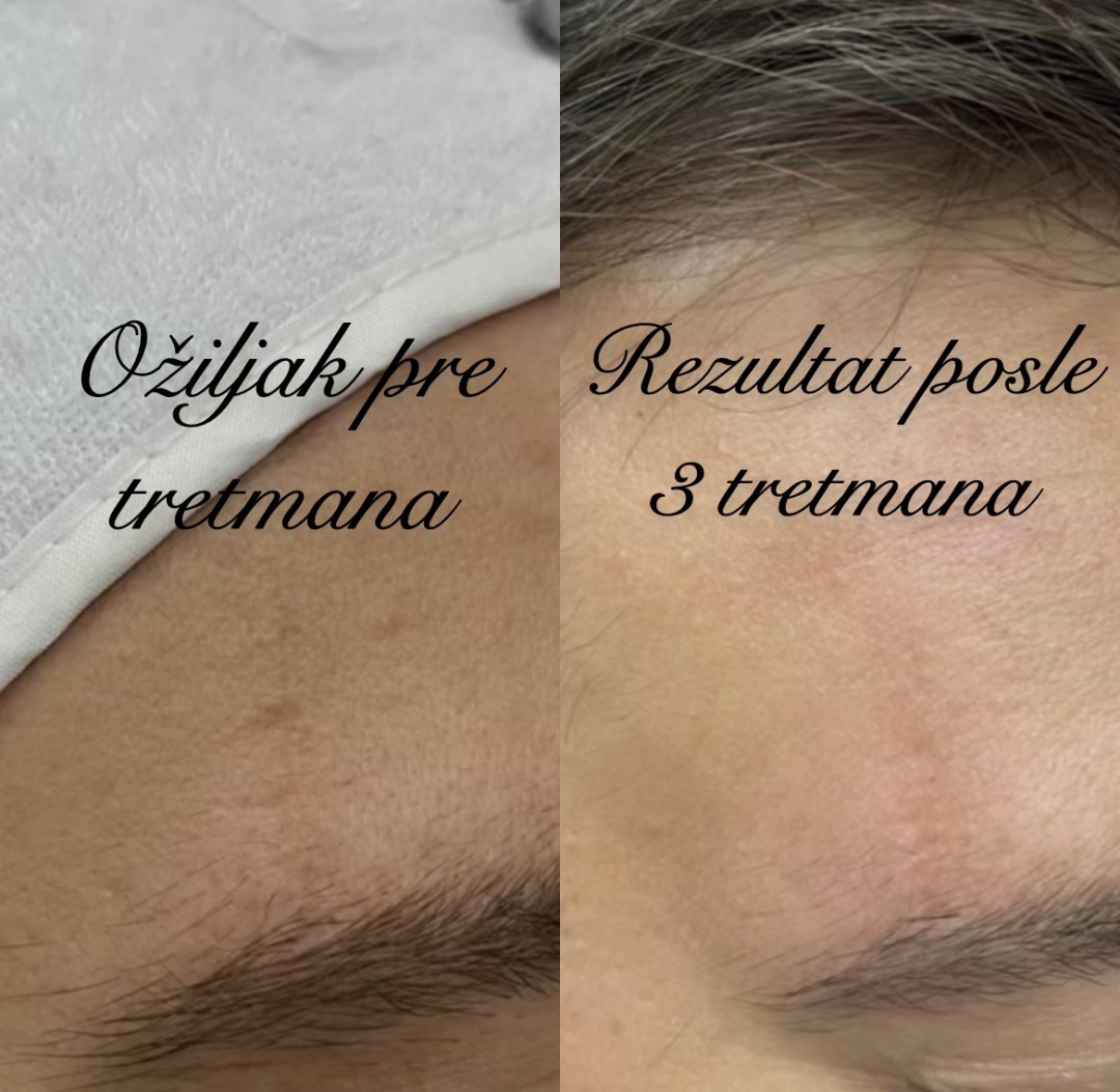Dermapen - ožiljci od akni - Estetski centar Vlahović, Beograd ...